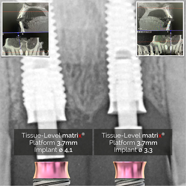 1-year follow-up: Tissue-Level implant in high esthetic zone - Dr. Joel ...