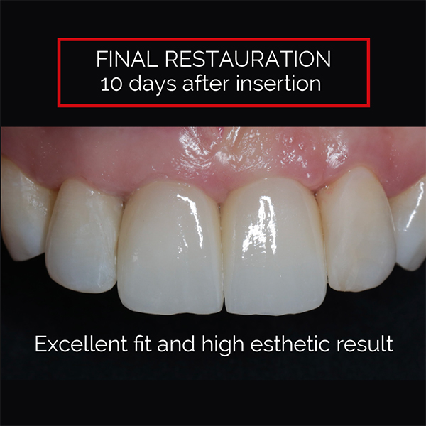 1-year follow-up: Tissue-Level implant in high esthetic zone - Dr. Joel ...