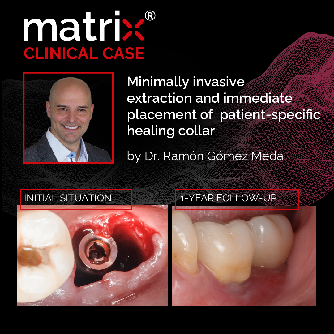 Minimally invasive extraction and immediate placement of patient ...