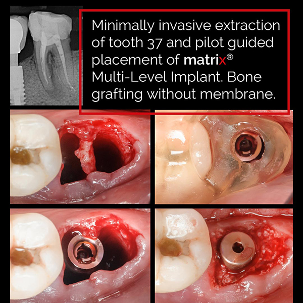 Minimally invasive extraction and immediate placement of patient ...