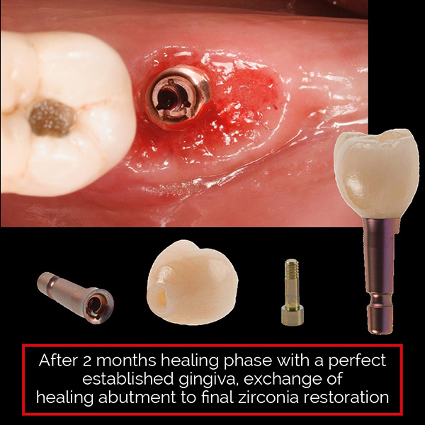 Minimally invasive extraction and immediate placement of patient ...