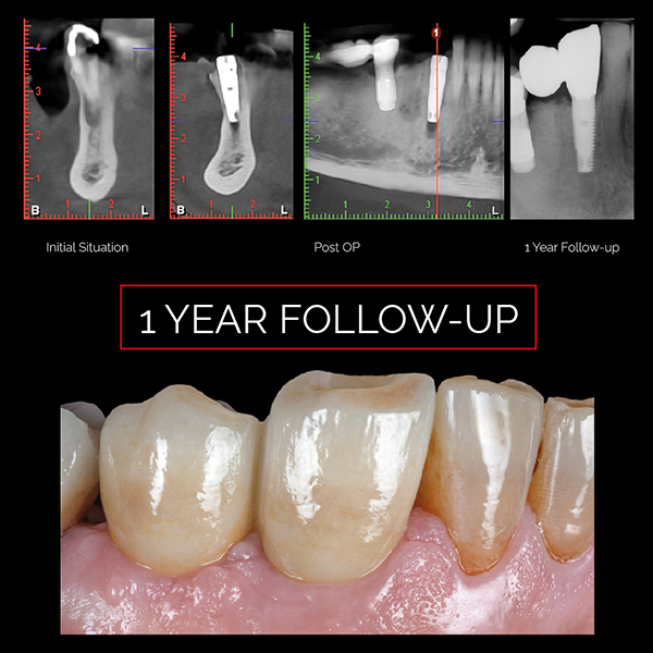 Two crowns on one matrix® Tissue- Level Implant - Dr. Ramón Gómez Meda