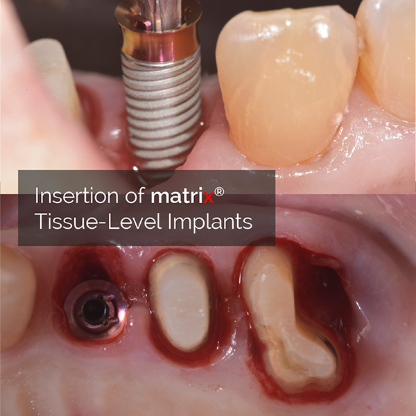 Fully digital treated esthetic single crowns on matrix® Tissue-Level ...