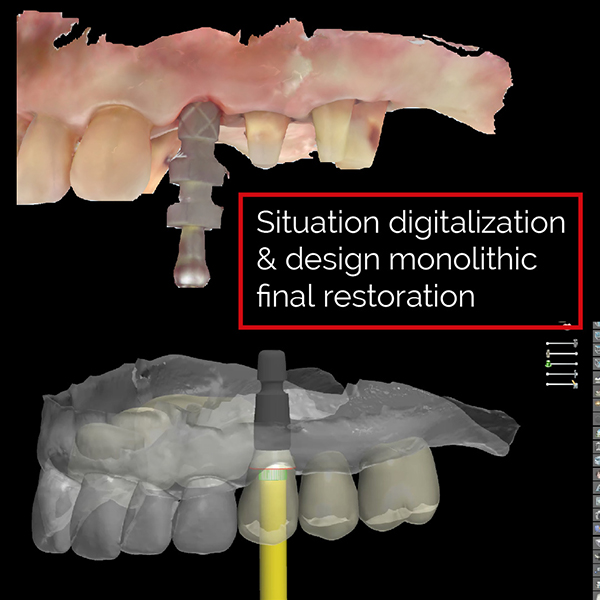 Fully digital treated esthetic single crowns on matrix® Tissue-Level ...