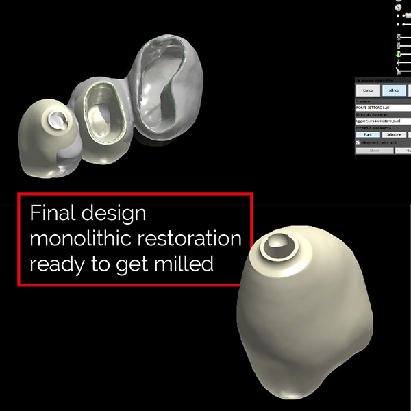 Fully digital treated esthetic single crowns on matrix® Tissue-Level ...