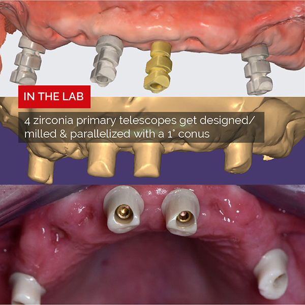 matrix® removable Full-Arch Restoration with 4 Zirconia Telescopes ...