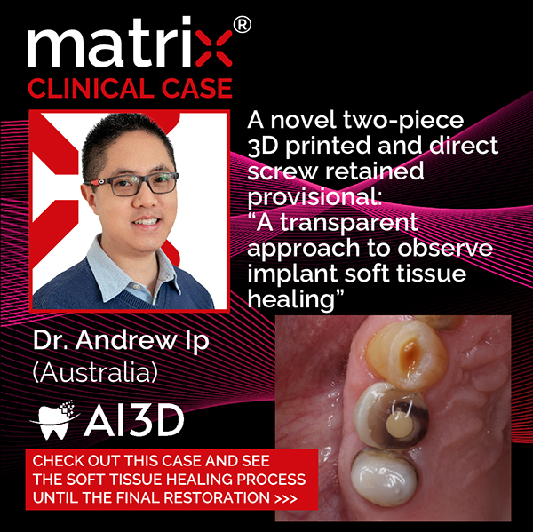 A novel two-piece 3D printed and direct screw retained provisional: “A ...