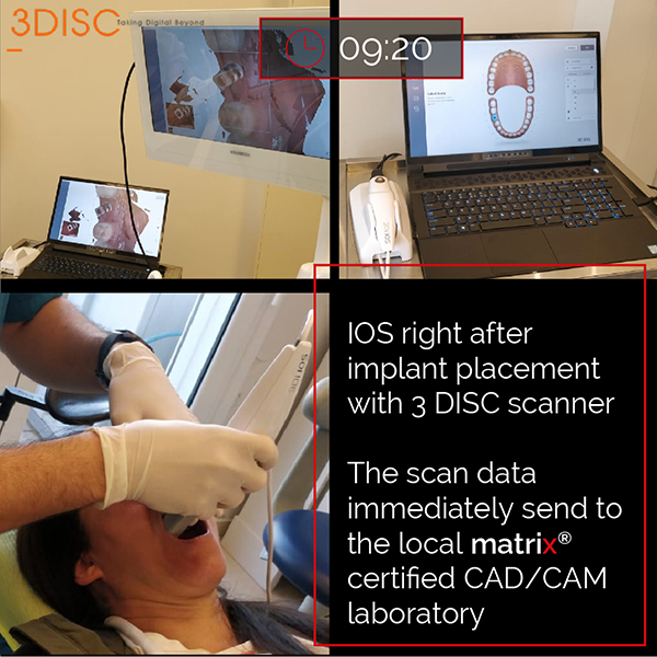 matrix® implant placement and temporary restoration in less than 2 ...