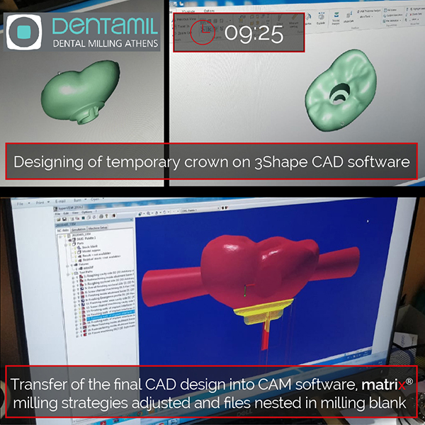 matrix® implant placement and temporary restoration in less than 2 ...