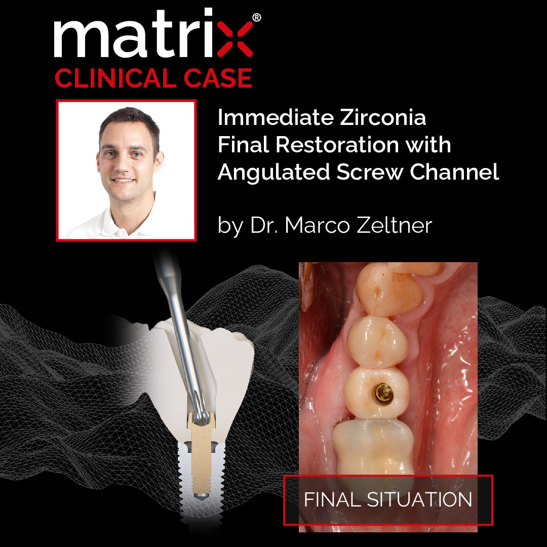 Immediate zirconia Final restoration with Angulated screw channel - Dr ...