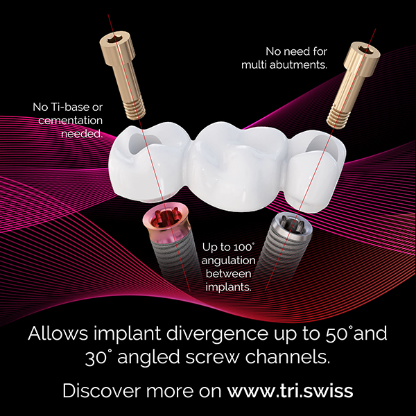 3 Unit Zirconia Bridge Directly Screw-retained On 2 Strongly Angulated ...