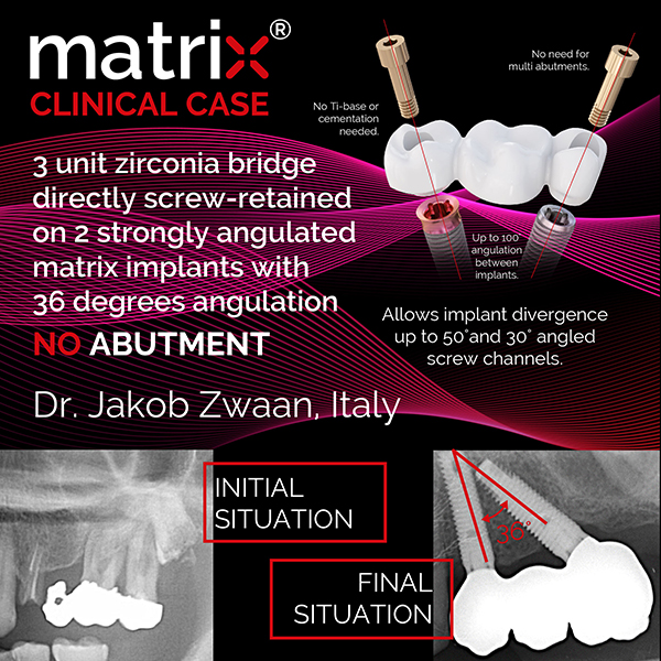 3 Unit Zirconia Bridge Directly Screw-retained On 2 Strongly Angulated ...
