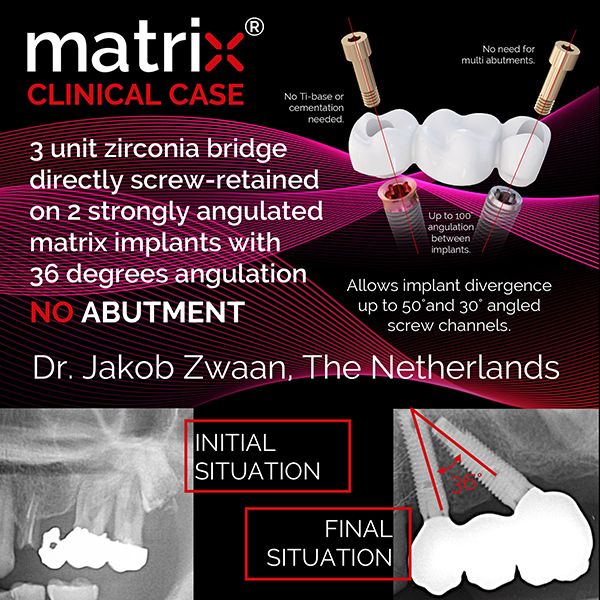 3 Unit Zirconia Bridge Directly Screw-retained On 2 Strongly Angulated ...
