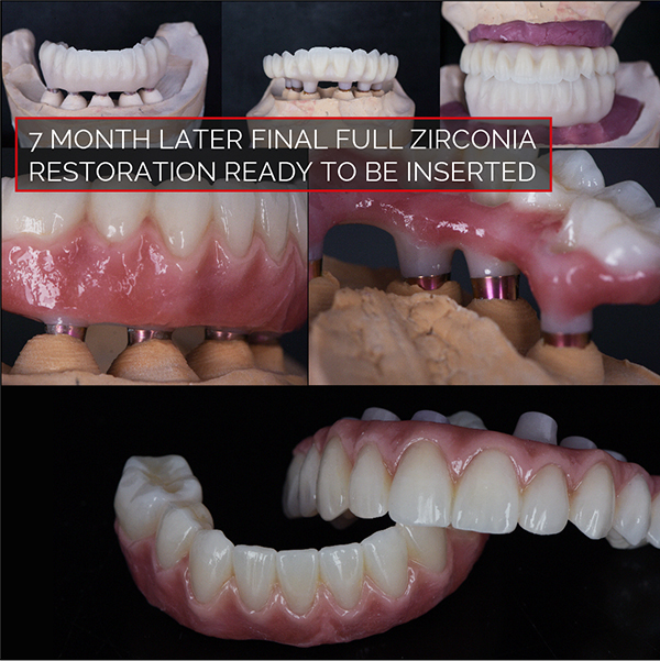 matrix® guided full-arch restoration with a 100% digital workflow - Dr ...