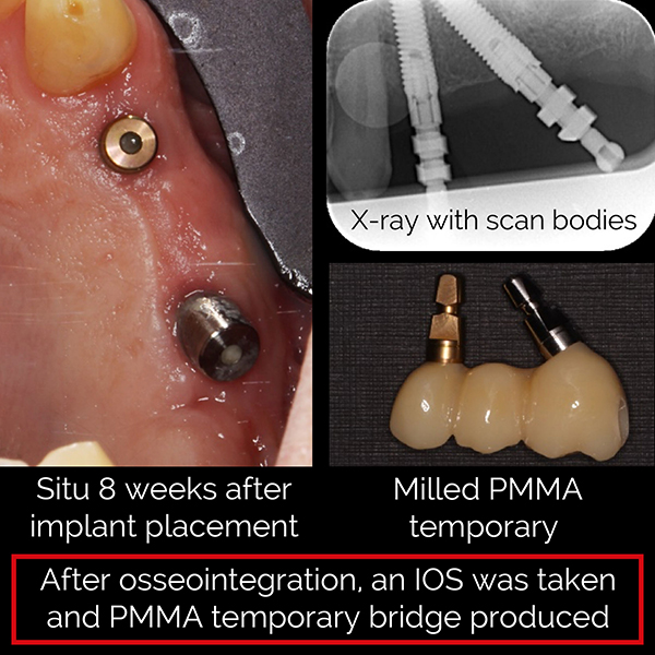 3 Unit Zirconia Bridge Directly Screw-retained On 2 Strongly Angulated ...
