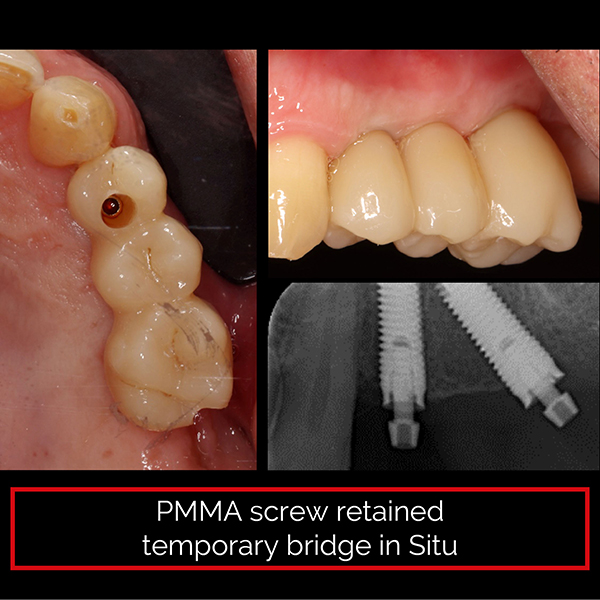 3 Unit Zirconia Bridge Directly Screw-retained On 2 Strongly Angulated ...