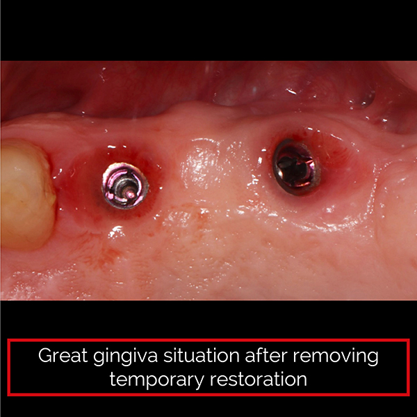3 Unit Zirconia Bridge Directly Screw-retained On 2 Strongly Angulated ...