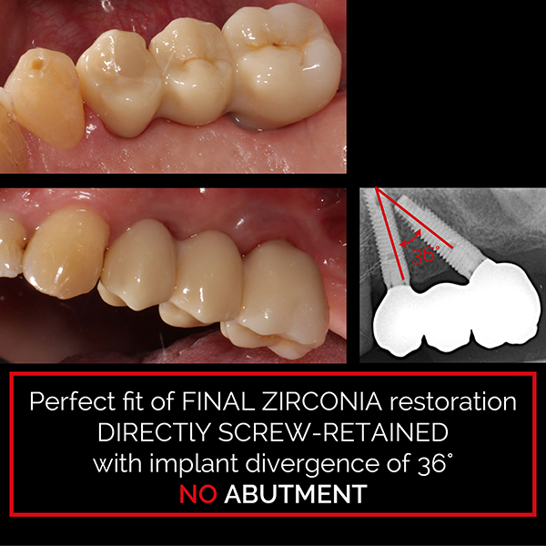3 Unit Zirconia Bridge Directly Screw-retained On 2 Strongly Angulated ...
