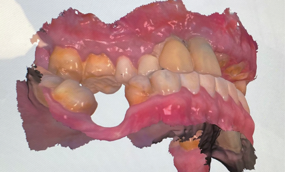 3D-Printing: matrix® 7 unit bridge extraction site 13, 12, 11, 22, 24