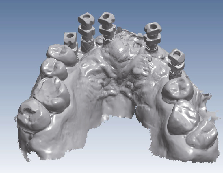 3D-Printing: matrix® 7 unit bridge extraction site 13, 12, 11, 22, 24