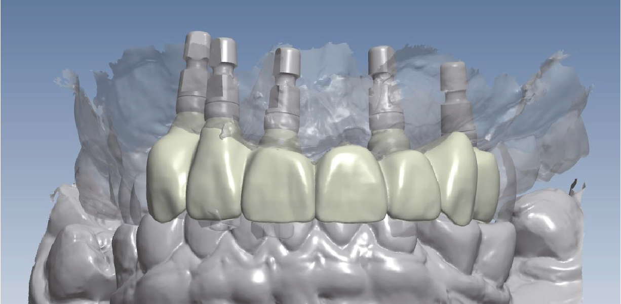 3D-Printing: matrix® 7 unit bridge extraction site 13, 12, 11, 22, 24