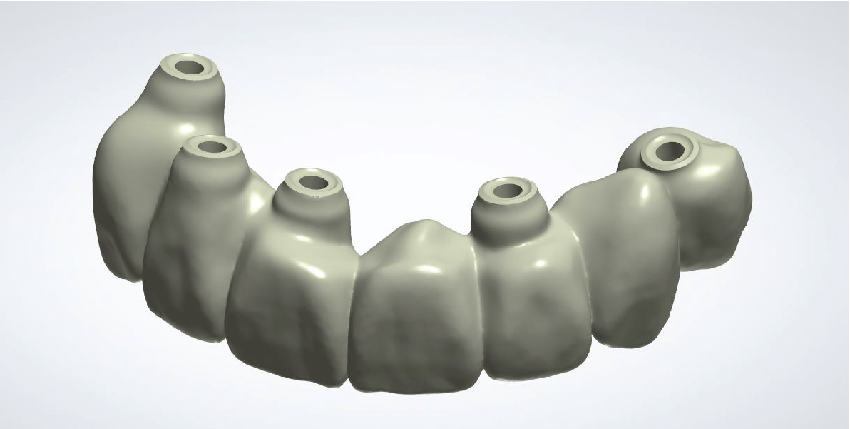 3D-Printing: matrix® 7 unit bridge extraction site 13, 12, 11, 22, 24