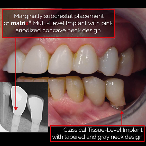 High Esthetic Advantages of matrix® Multi-Level Implants with a pink ...