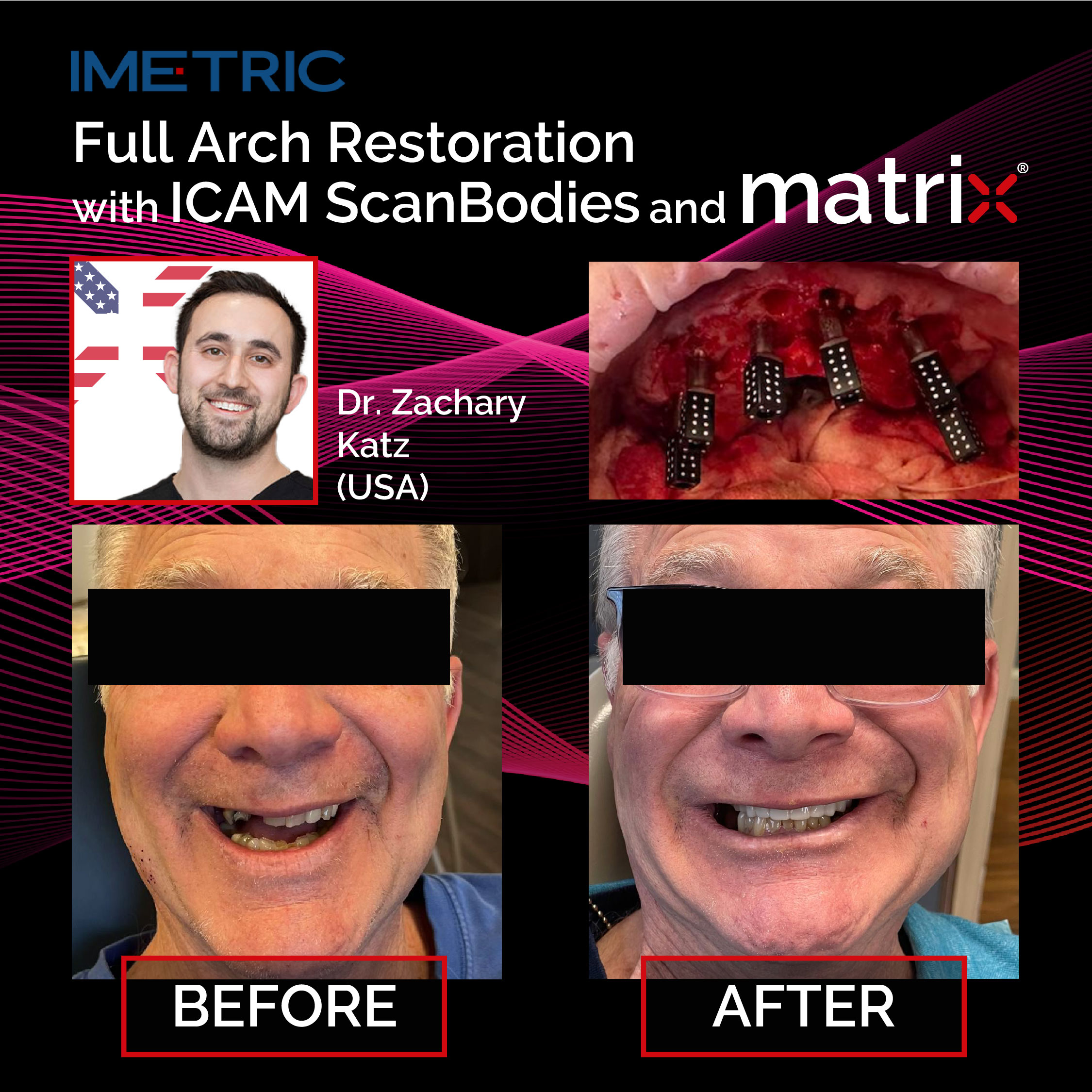 Full Arch Restoration with ICAM ScanBodies and matrix